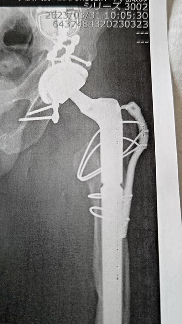 脚延長手術フェーズ2 術後12日 レントゲン: グリーゼ581h
