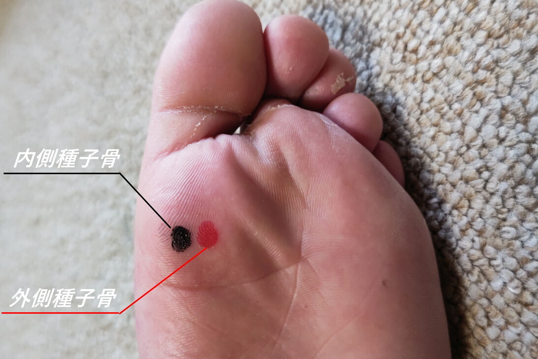 【前編】母趾球 圧痛時の痛み 独自調査再び1: グリーゼ581h