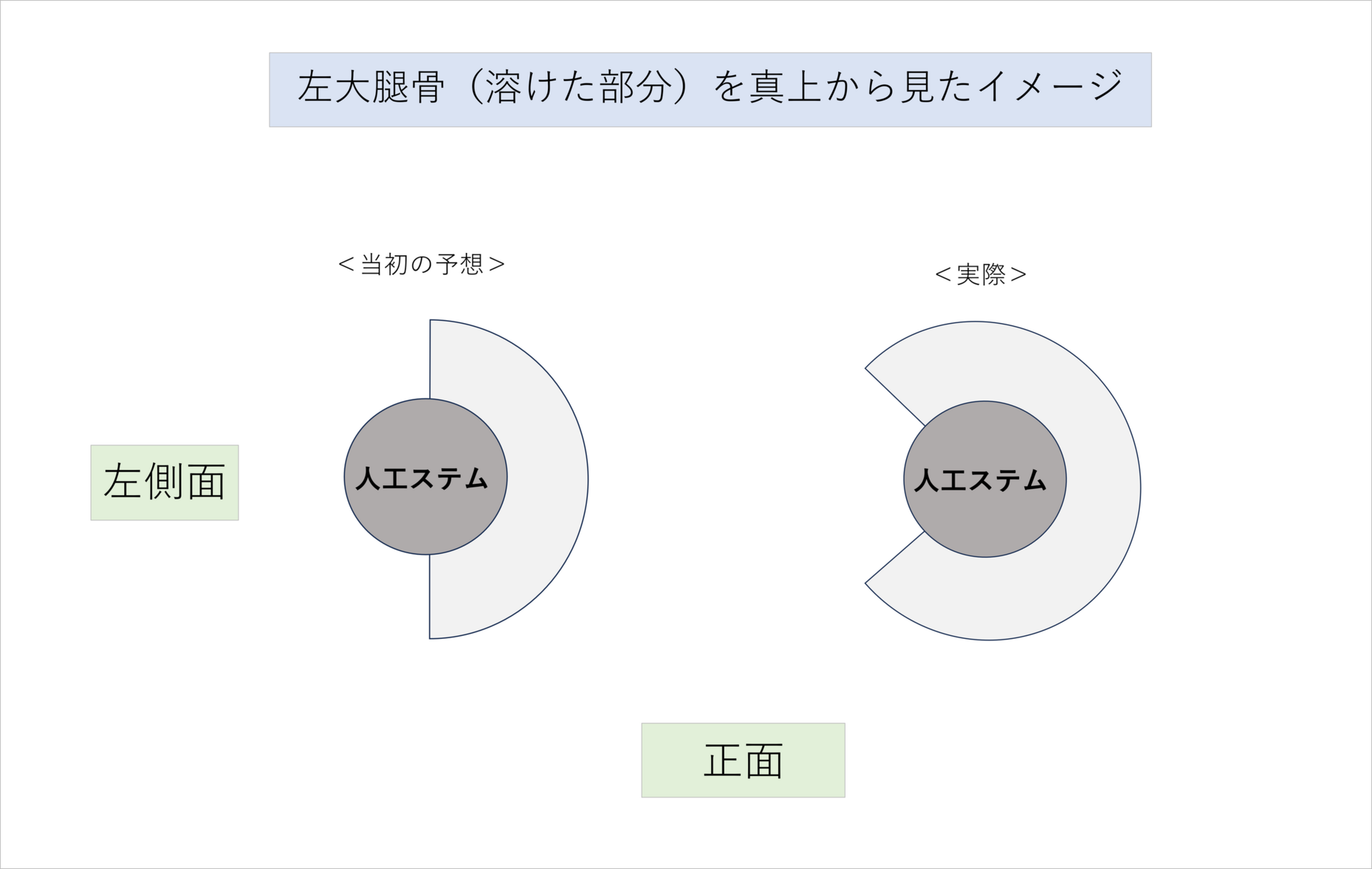 整形外科 CRP炎症値 溶けた大腿骨の状態確認: グリーゼ581h
