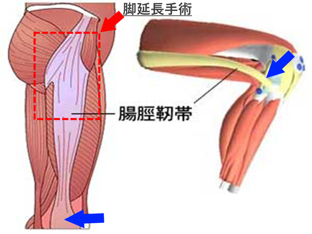 脚延長術 屋外歩行リハ 片松葉歩行 見極め: グリーゼ581h